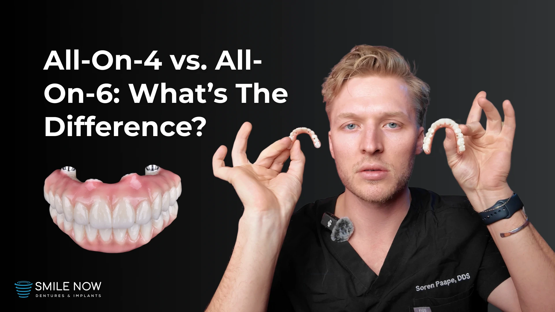 All On 4 Vs All On 6 Dental Implants: Pros, Cons, And The Entire ...